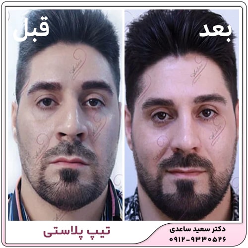 تیپ پلاستی بینی چیست؛ بررسی هزینه و عوارض عمل نوک بینی